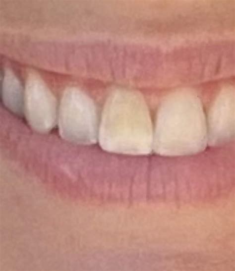 Tooth Discoloration Rmedical