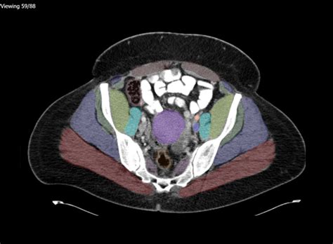 Pelvis Ct Slice 59 Diagram Quizlet