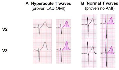 Hyperacute T Waves