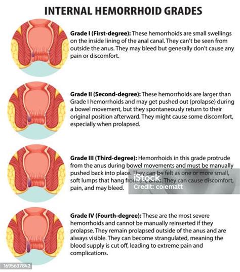 Educational Infographic Internal Hemorrhoid Grades Stock Illustration