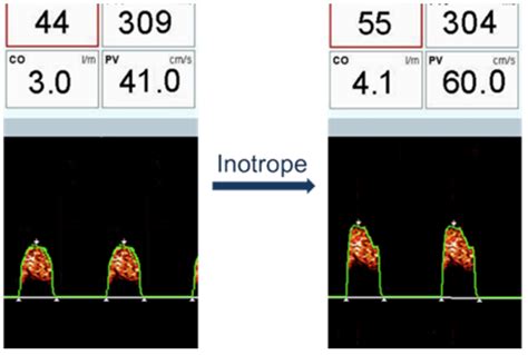 Preload Afterload And Contractility