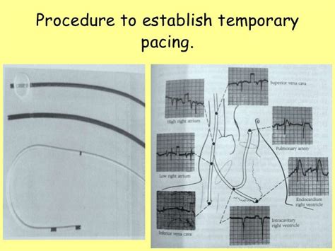 Dr Hardik Temporary Pacemaker Preview 1