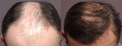 Scalp Reduction Before And After Pictures Case 1056 Rochester