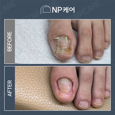 창원 진해 문제성발톱 창원 진해 내성발톱and발톱무좀 당신의 편안한 일상 Always Np케어 ⚠ 무료상담and예약문의 ⚠ Tel 010 5014 8125 🚕 창원시