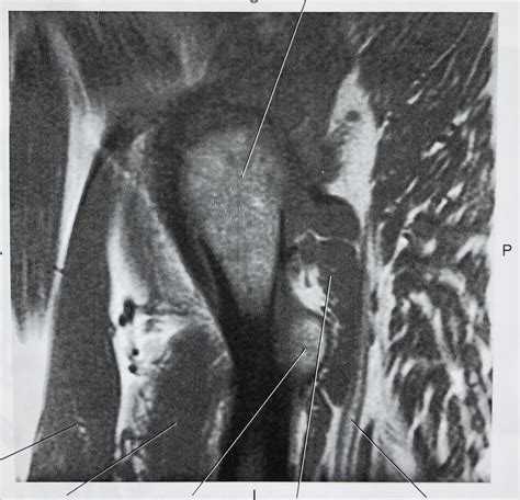 Sagittal T1 Sciatic Nerve Diagram Quizlet