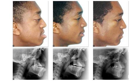 Treatment Of Midfacial Hypoplasia In Syndromic And Cleft Lip And Palate