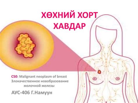 Хөхний хорт хавдар Pptx