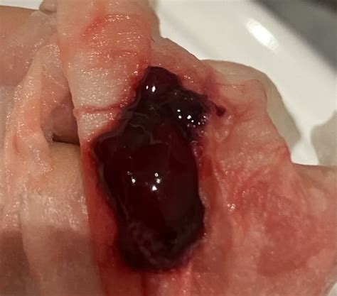 Does This Look Like A Miscarriage Content Warning Mumsnet