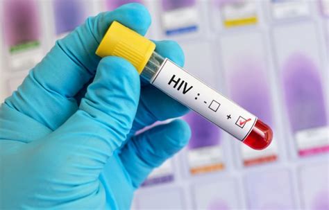 एचआईवी एड्स के लक्षण कारण इलाज दवा उपचार और परहेज Hiv Aids