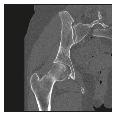 A Ap Pelvic X Ray Showing A Stress Fracture Of The Right Femoral