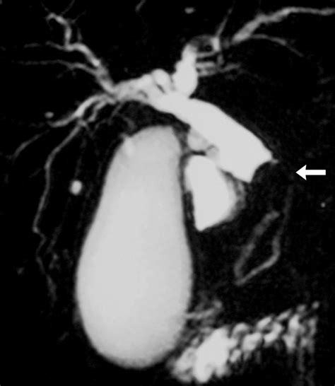 Unusual Presentation Of A Distal Cholangiocarcinoma Abstract Europe Pmc