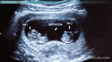 Twins And Multiple Births Medical Vocabulary Lesson