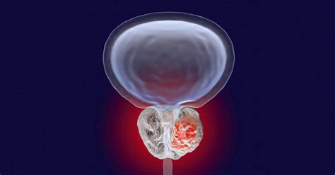 Navigating Medical Oncology Treatments For Prostate Cancer A
