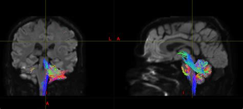 Tractography Pipeline Mrtrix Community