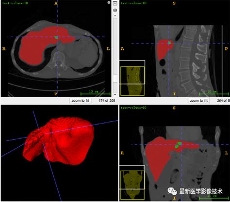 2018medical Segmentation Decathlon——10项医学分割任务之task3肝脏肿瘤分割 腾讯云开发者社区 腾讯云
