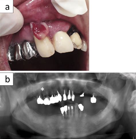 Figure4histopathological Characteristics Of Case 2 A B Hematoxylin