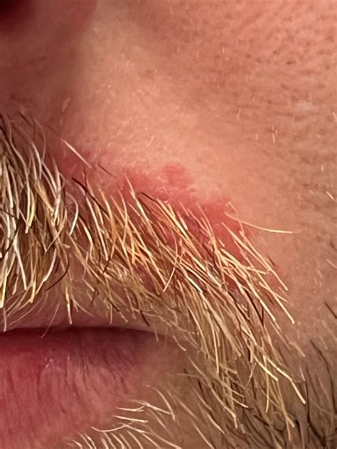 Beard Rash Advice Rbeards