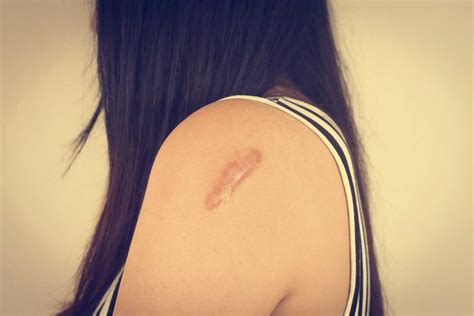 Keloid Injection Dress Your Skin With The Glow