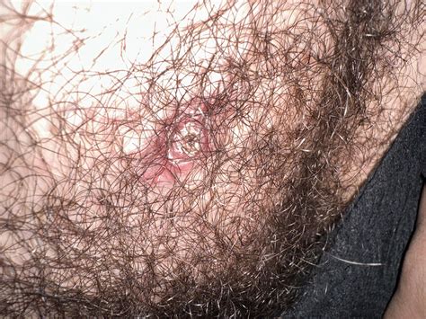 Cyst Pimple Ingrown Hair Infected Help Rmedicalhelp