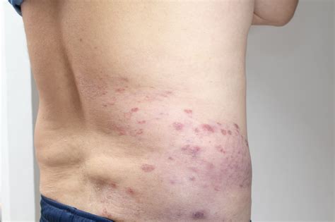What Is Shingles Pain Comparable To At Rosemary Henry Blog