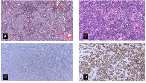 Two Exemplificative Cases Of Lung NET Comparing TTF Expression Download Scientific Diagram
