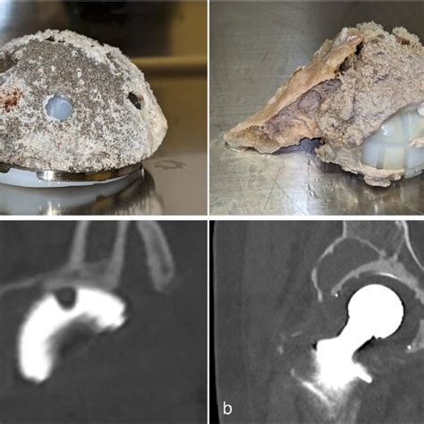 Retrieved Uncemented A And Cemented B Acetabular Cup Implant And Download Scientific