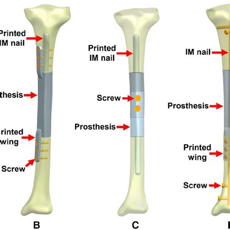 Five Types Of 3d Printed Prostheses And Fixation Modes Im