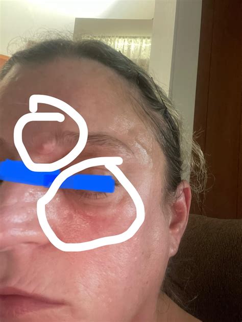 Please Help I Woke Up With My Under Eye Swollen It Started Off As A
