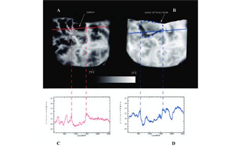 Reorganization Of Cortical Temperature Gradients After Tumor Resection Download Scientific