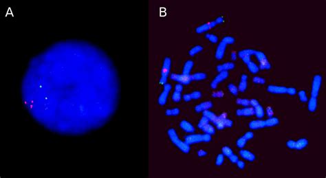 Fish Analysis For Alpha Synuclein Gene Panel A Presents An Interphase
