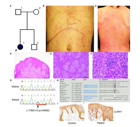 Clinicopathologic Features Of The Present Patient With A Jak1