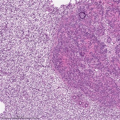 Pathology Outlines Low Grade Endometrial Stromal Sarcoma