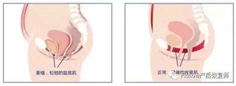 盆底康复从glazer评估开始。 收缩