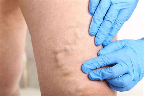 Thrombophlebitis 10 Symptoms Of Thrombophlebitis