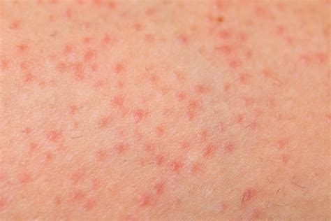 Folliculitis Auckland Skin Clinic