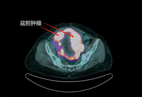 大连医科大学附属第一医院 要闻聚焦 奋战4小时！直径约12cm的肿瘤被成功切除！