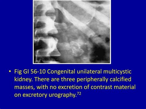 56 Renal Calcification Pptx