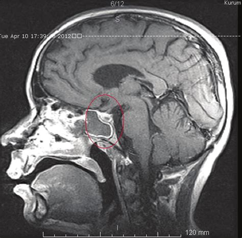 Pituitary Magnetic Resonance Imaging Before Treatment Figure 2