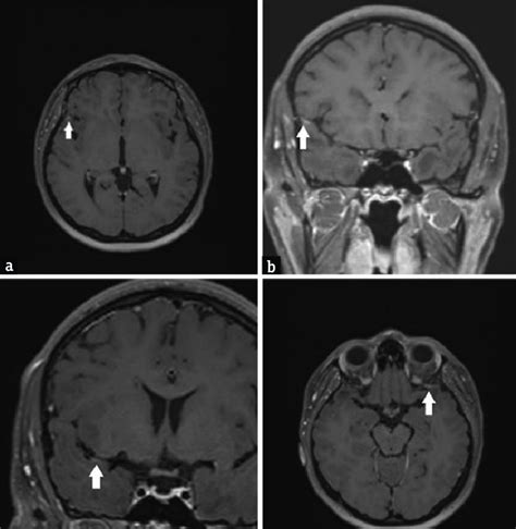 A Contrast Enhancement In The Wall Of Middle Cerebral Artery M2