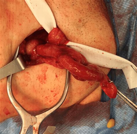 Inflamed Appendix Mobilized From Hernia Sac Prior To Appendectomy Download Scientific Diagram