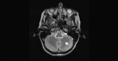 Hope Victory Over Multiple Sclerosis Mri Lesions Gone