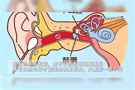 小伙被女友亲到鼓膜破裂噗一声后瞬间听不清一两月才恢复