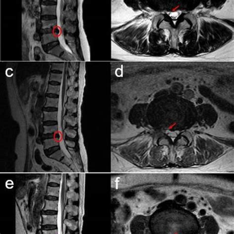 Preoperative And Postoperative Mri Of One Patient Notes A And B The