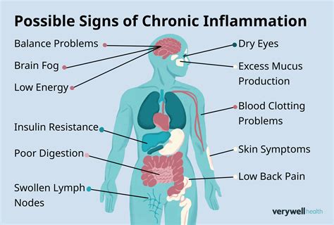 Chronic Inflammation Nguyên Nhân Triệu Chứng Và Cách Điều Trị Hiệu Quả