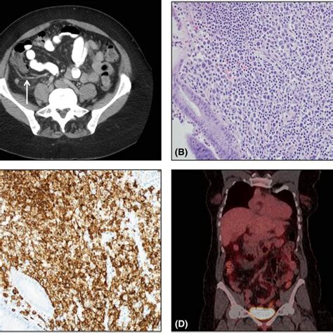 A Ct Scan Showing A Dilated Appendix With Periappendiceal Stranding