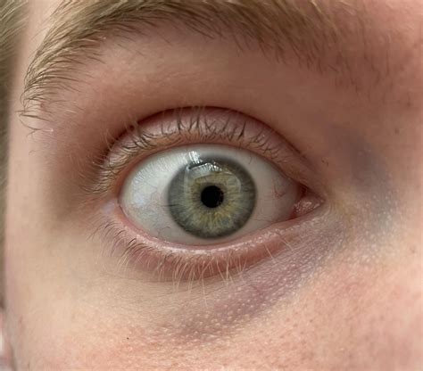 Not Sure What Color To Classify My Eyes As Im Also Partially