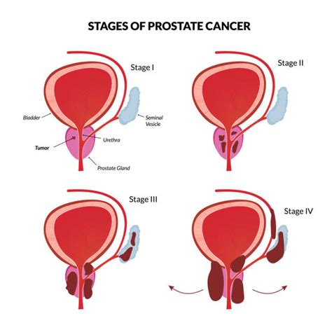 Prostate Hypertrophy Illustrations Royalty Free Vector Graphics And Clip