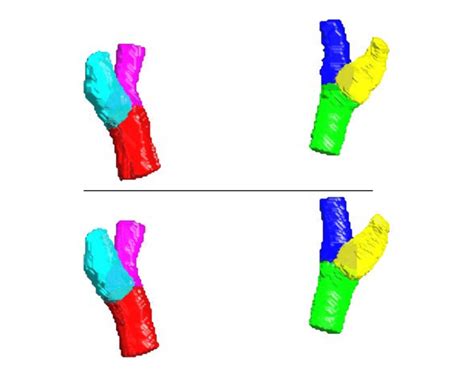 11 comparison of automatically generated segmentation of the carotid