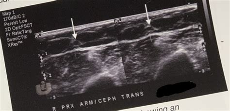 Upper Lower Extremity Duplex Mapping Flashcards Quizlet