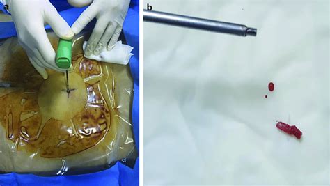 A And B All The Interventions Performed Under Aseptic Conditions By